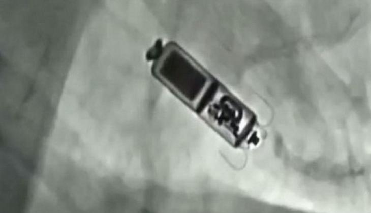 78-year-old receives world's smallest leadless pacemaker | Catch News
