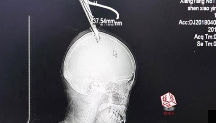 OMG! Woman with two scissors stuck in her head takes bus to reach ...